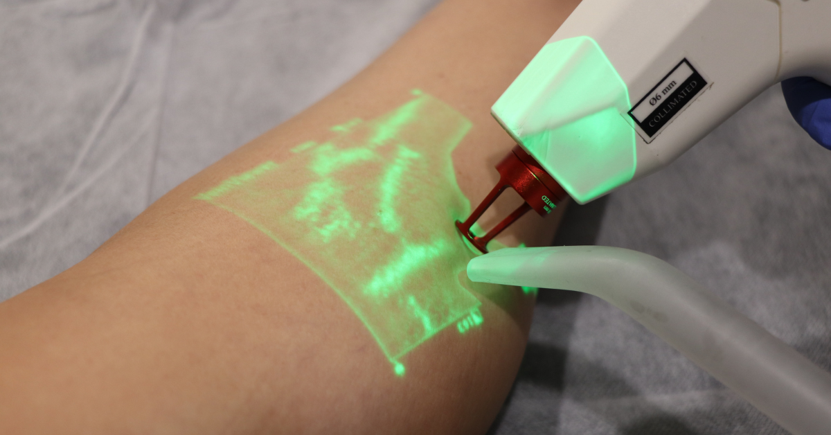 Spider Vein Laser vs Radiofrequency - Spider Veins Australia